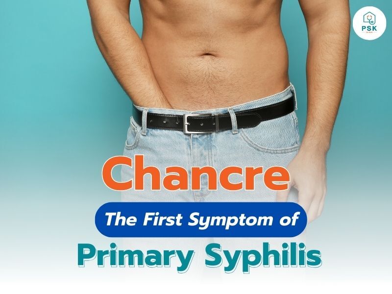 Syphilis Chancres : How to Distinguish and Treat Effectively
